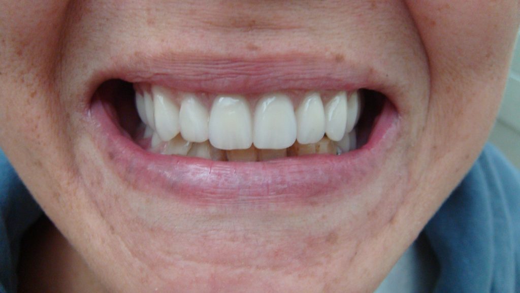 Dentures Lansdowne VA | Denture Repair Ashburn VA