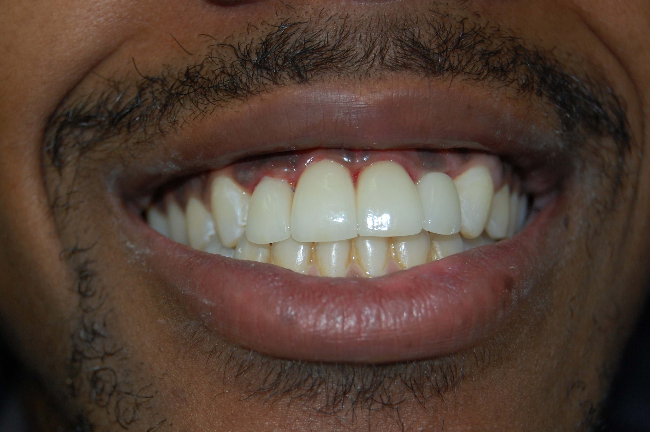 Dental Veneers Lansdowne VA | Veneers for Teeth Ashburn VA